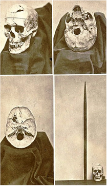 Changes Following a Traumatic Brain Injury: Does a person become their ...